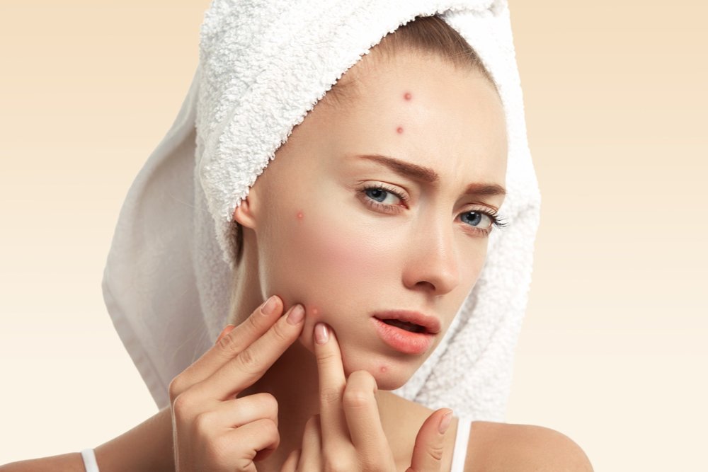 The Best Treatments for Acne-Prone Skin - Dr Geetika – SkinbydrG