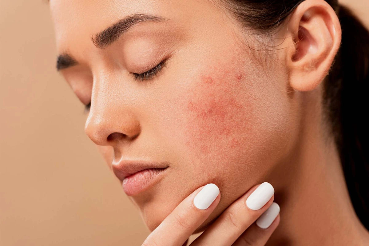 How to Treat Acne at Home That Actually Works - Dr Geetika – SkinbydrG